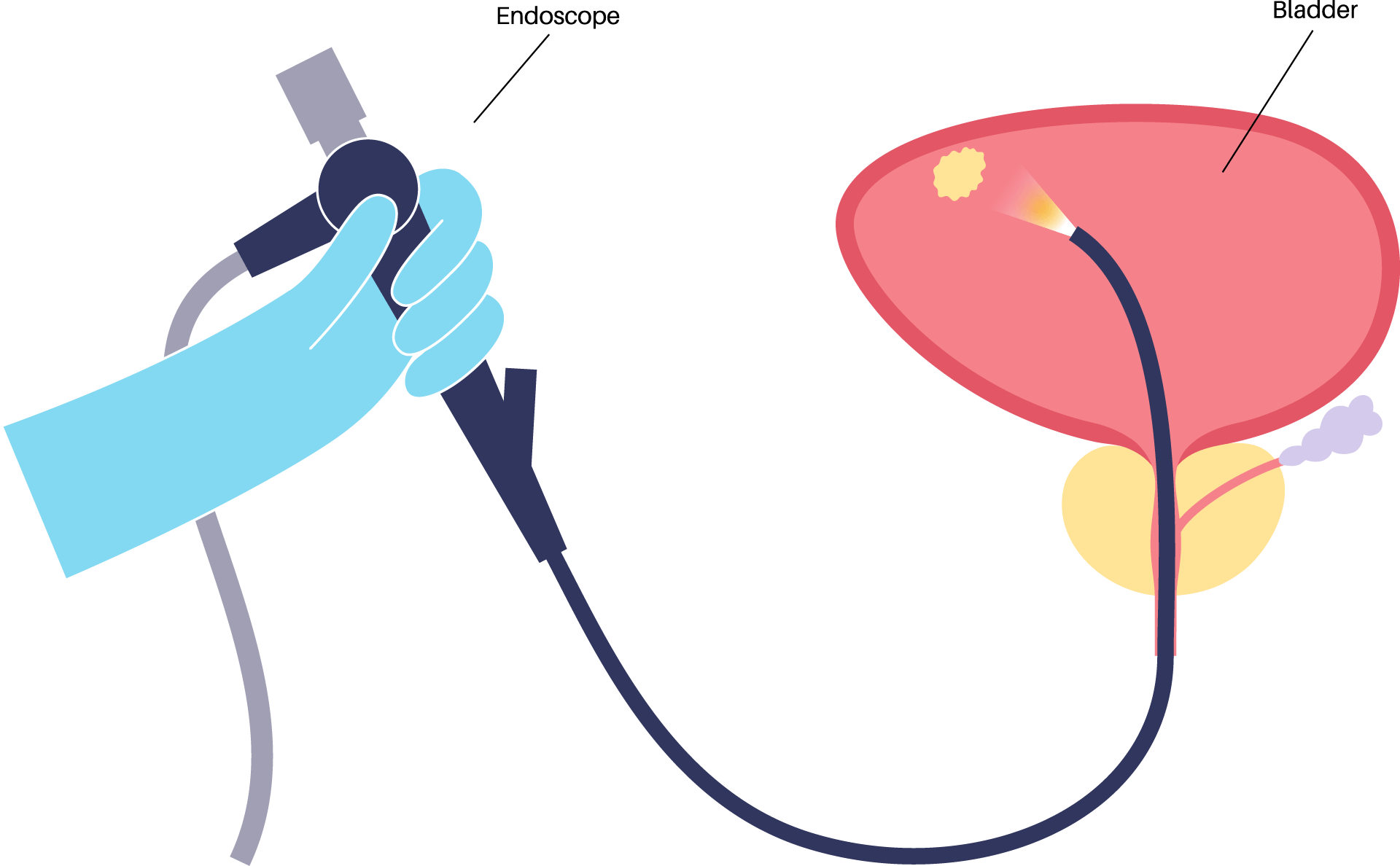 Cystoskopi - Urology For Life